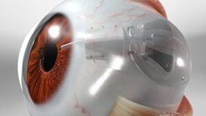 Glaucoma Tube Shunt Surgery in US (2025 Cost & Recovery Guide)