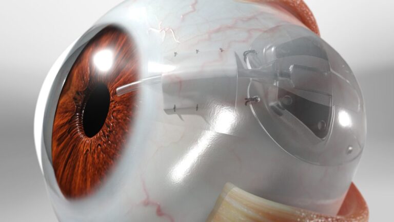 Glaucoma Tube Shunt Surgery in US (2025 Cost & Recovery Guide)