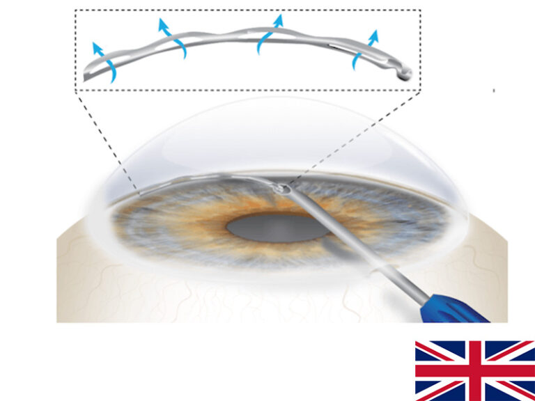 Hydrus Microstent Cost UK – Pricing & Recovery