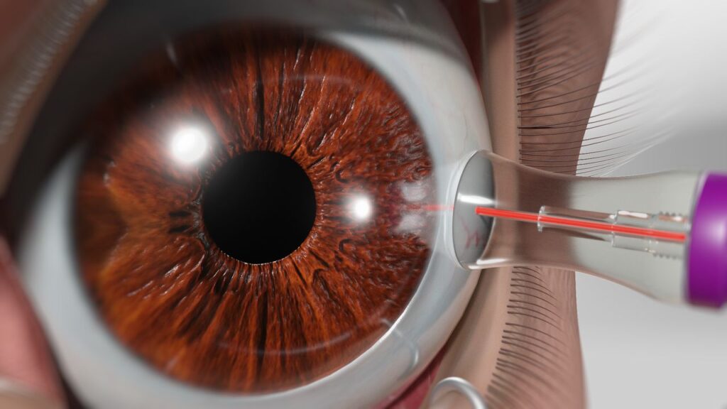 Laser Cyclophotocoagulation (CPC) in the U.S. Guide 2025
